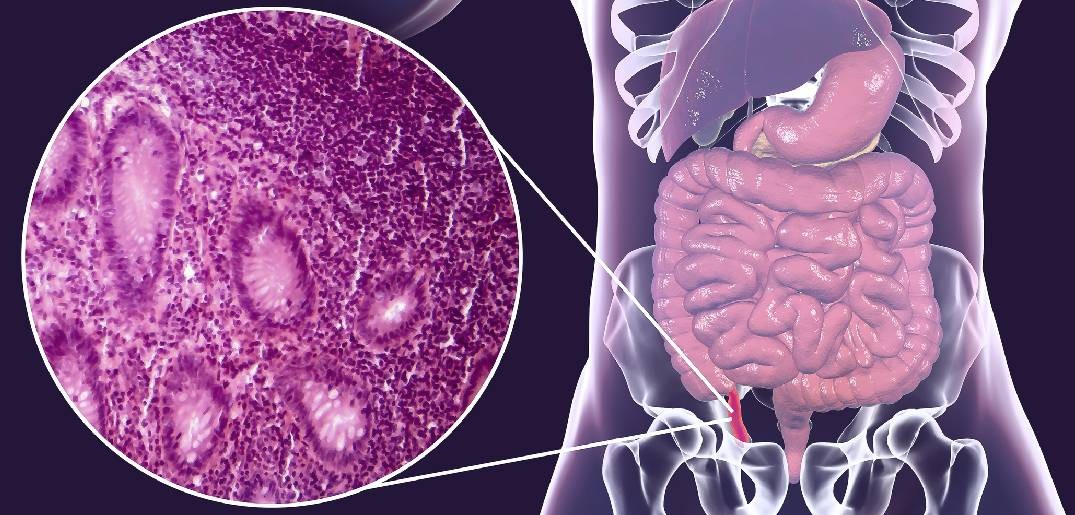 Inflammatory bowel disease